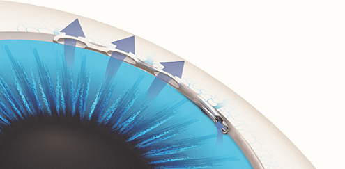 MIGS Glaucoma Treatment | Cumberland Eye